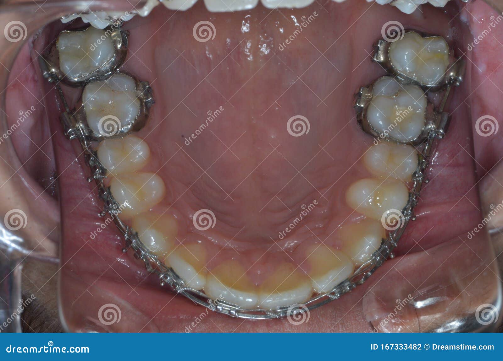 Braces Treatment on Male Teeth Stock Photo - Image of teeth, overbite ...