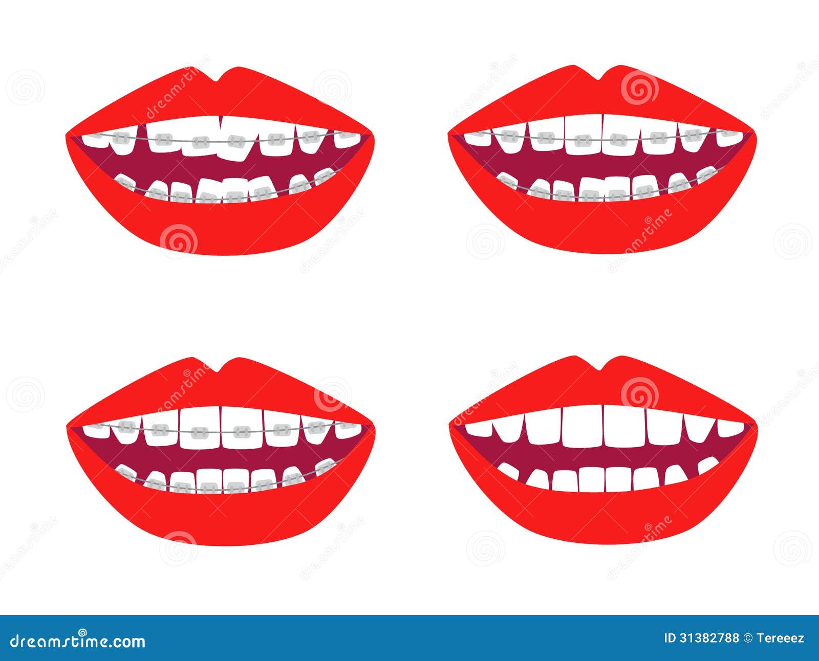 Braces vector set stock vector. Illustration of clipart - 31382788