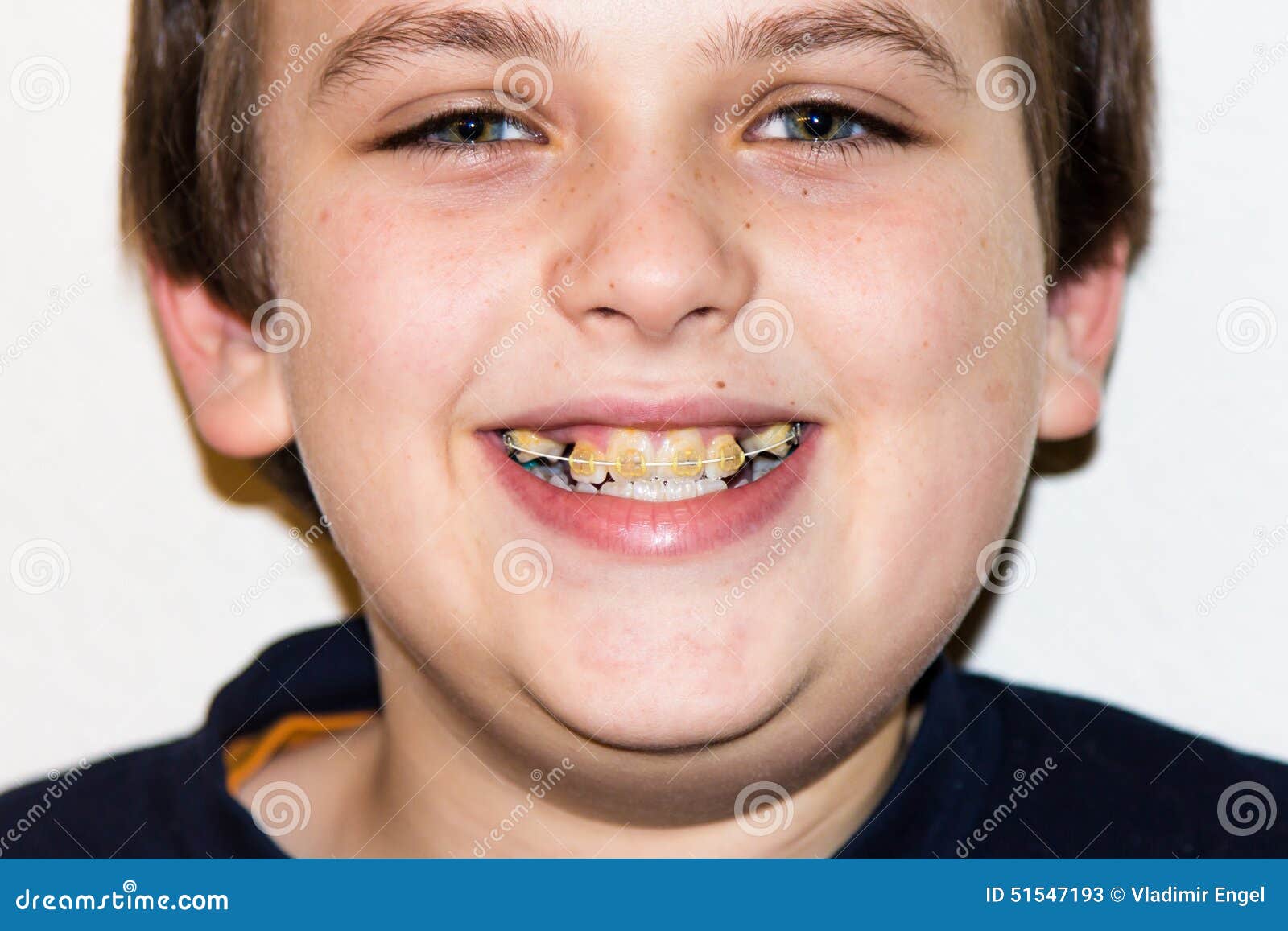 Braces and White Teeth of Smiling Boy Dentist Providence Stock Image ...