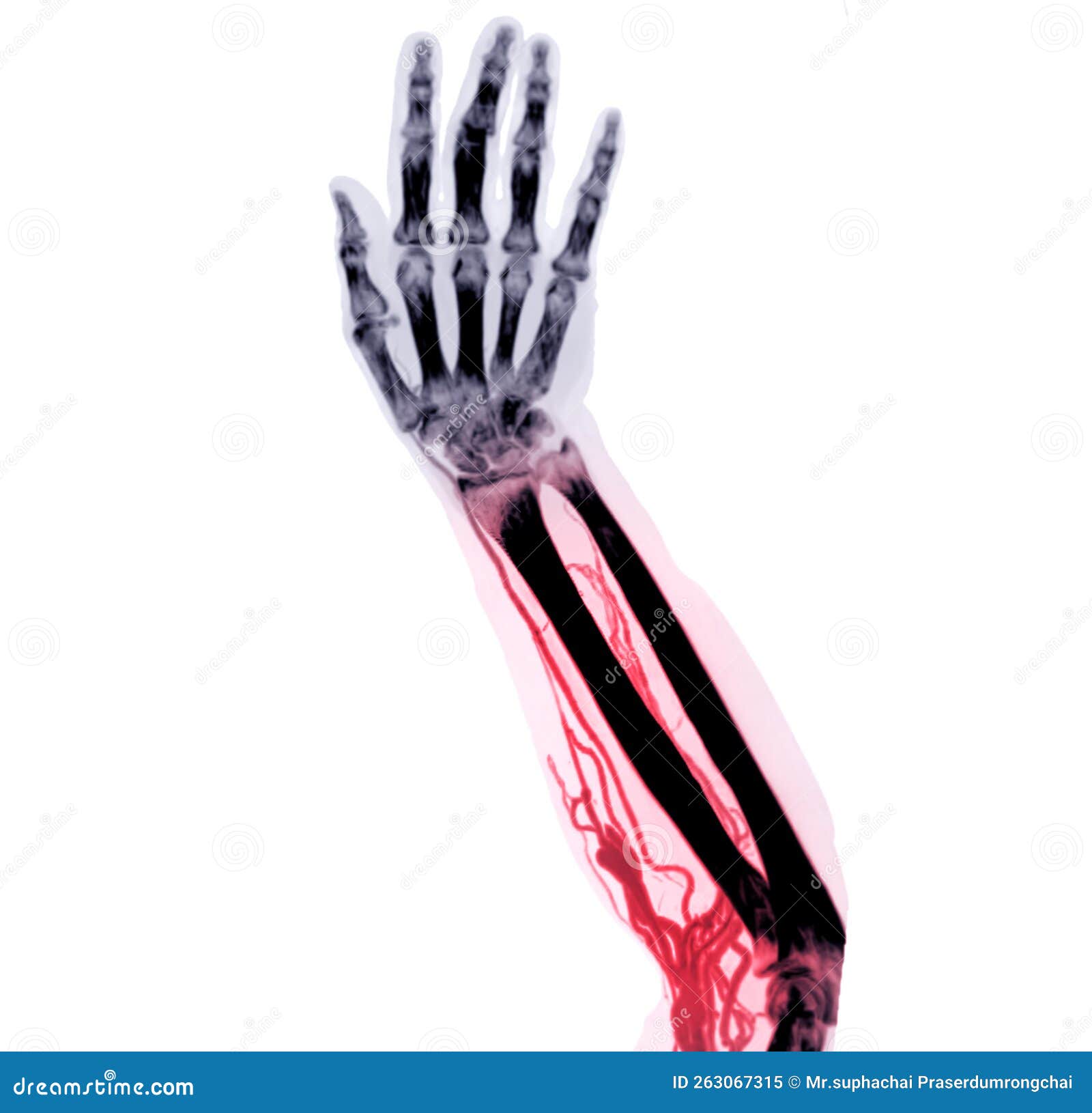 Brachial Arteries Of The Arm With Upper Extremity Bone 3D Rendering ...