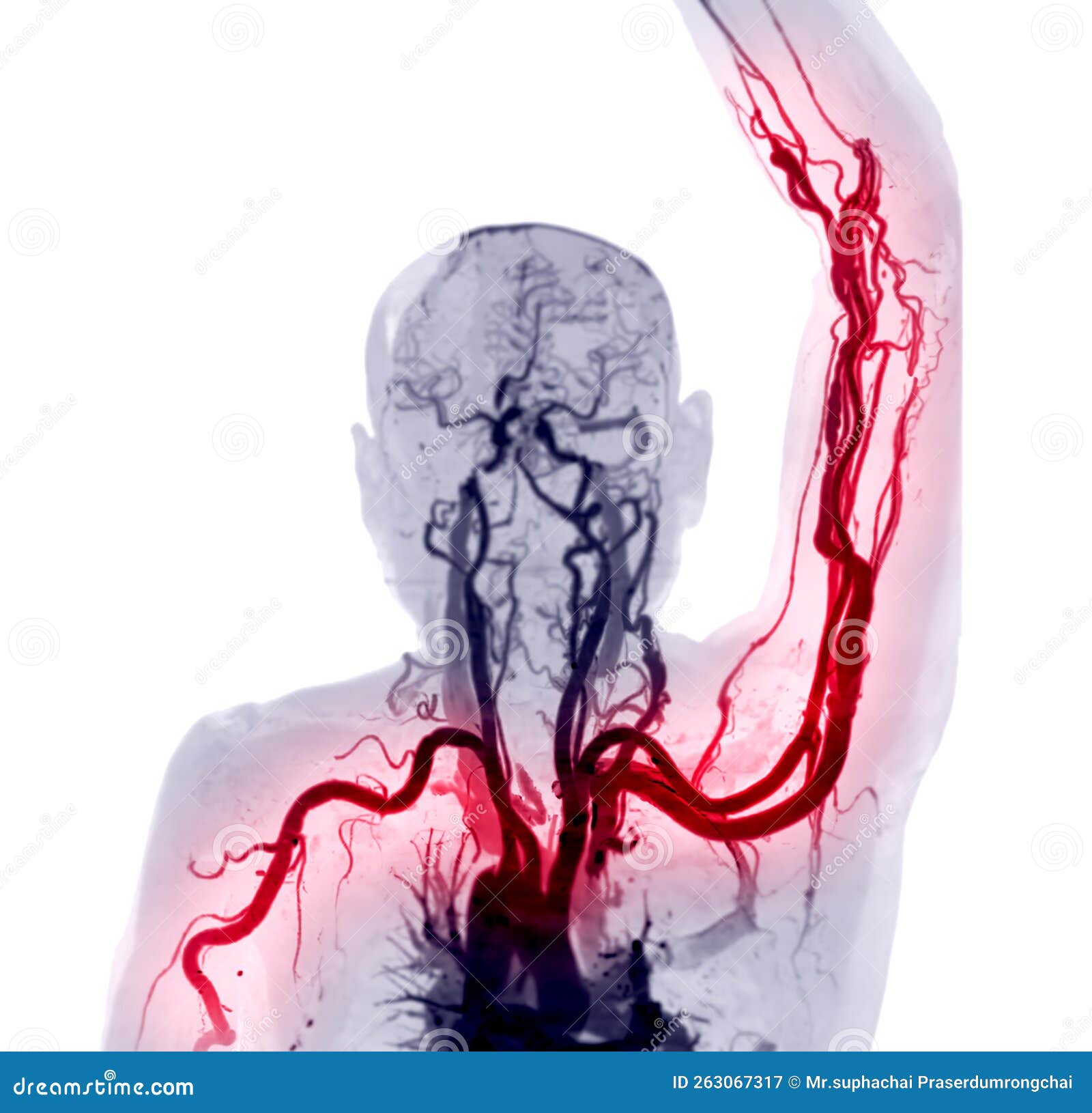 Brachial Arteries Of The Arm With Upper Extremity Bone 3D Rendering ...