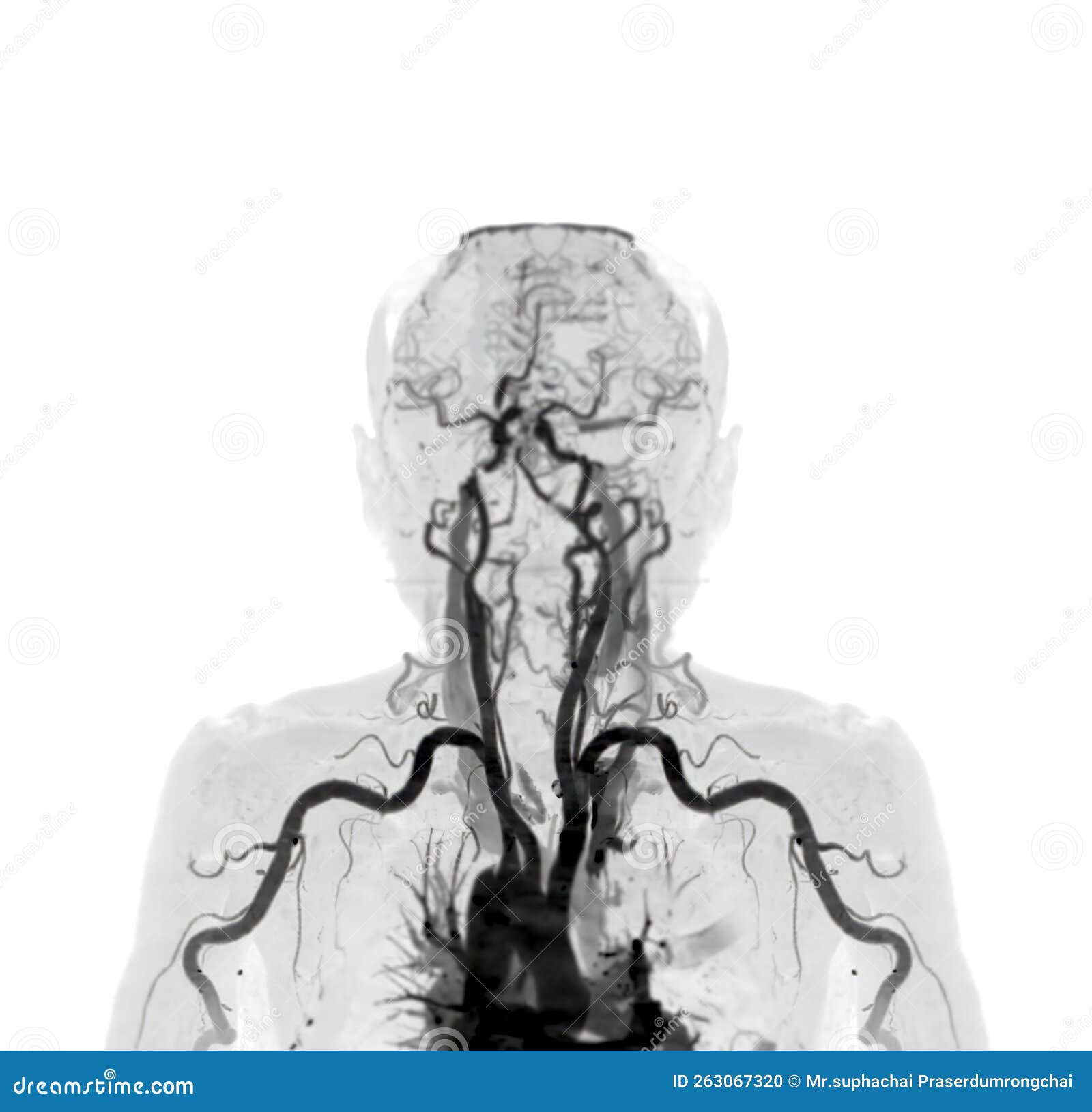 Brachial Arteries of the Arm with Upper Extremity Bone 3D Rendering ...