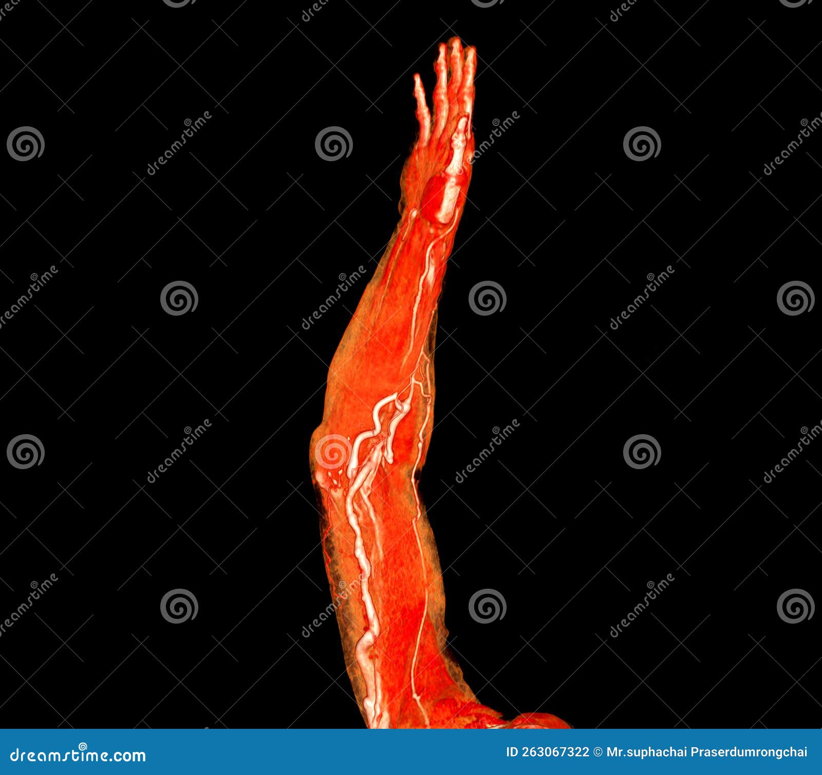 Brachial Arteries of the Arm with Upper Extremity Bone 3D Rendering ...
