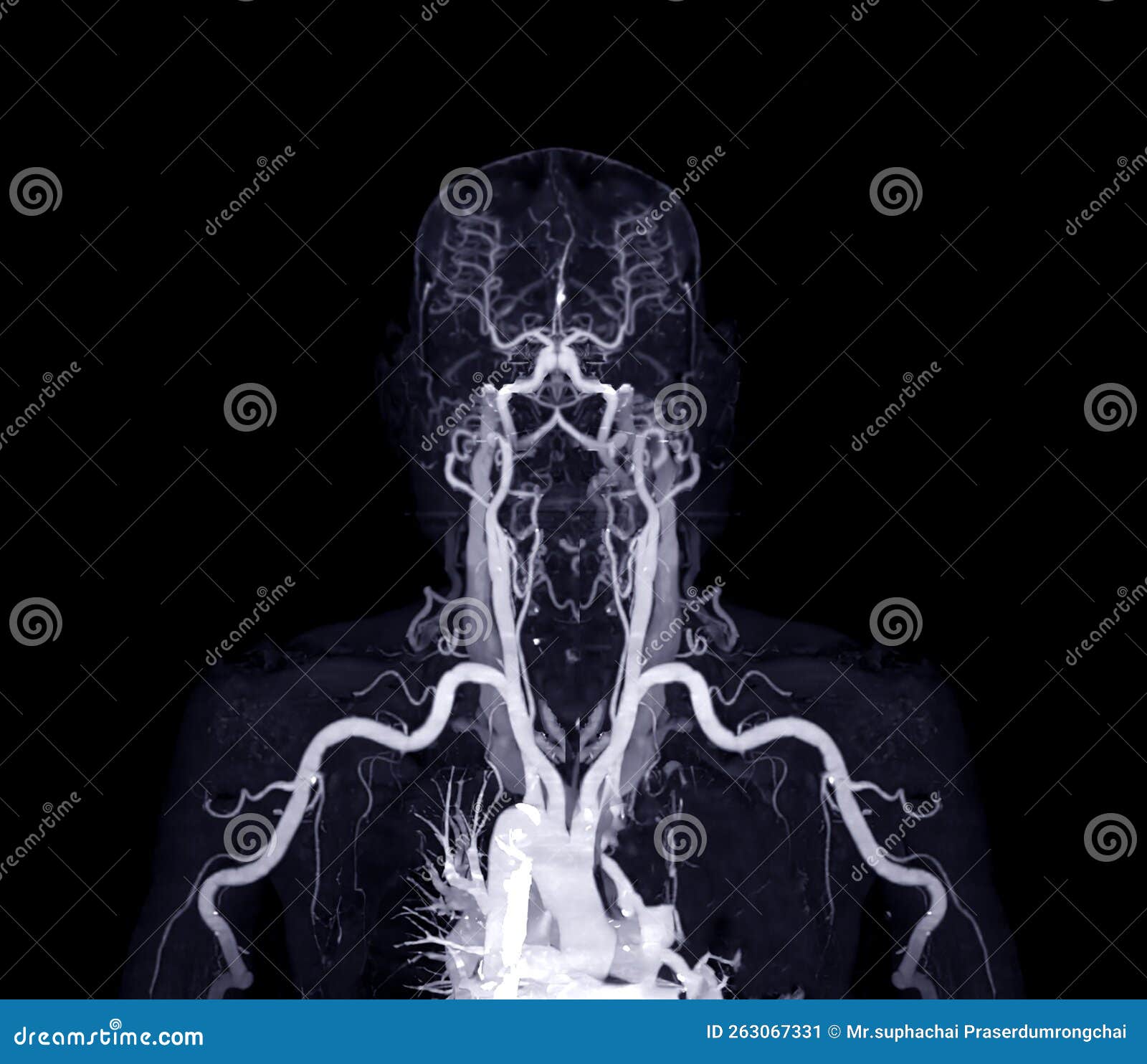 Brachial Arteries Of The Arm With Upper Extremity Bone 3D Rendering ...