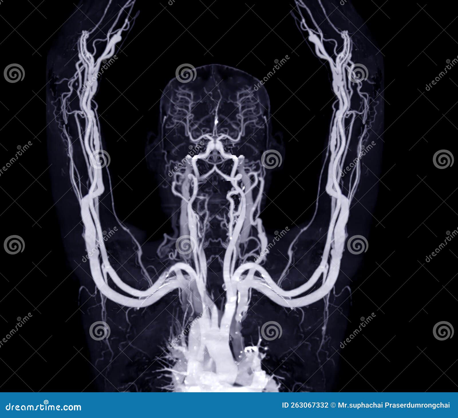 Brachial Arteries of the Arm with Upper Extremity Bone 3D Rendering ...