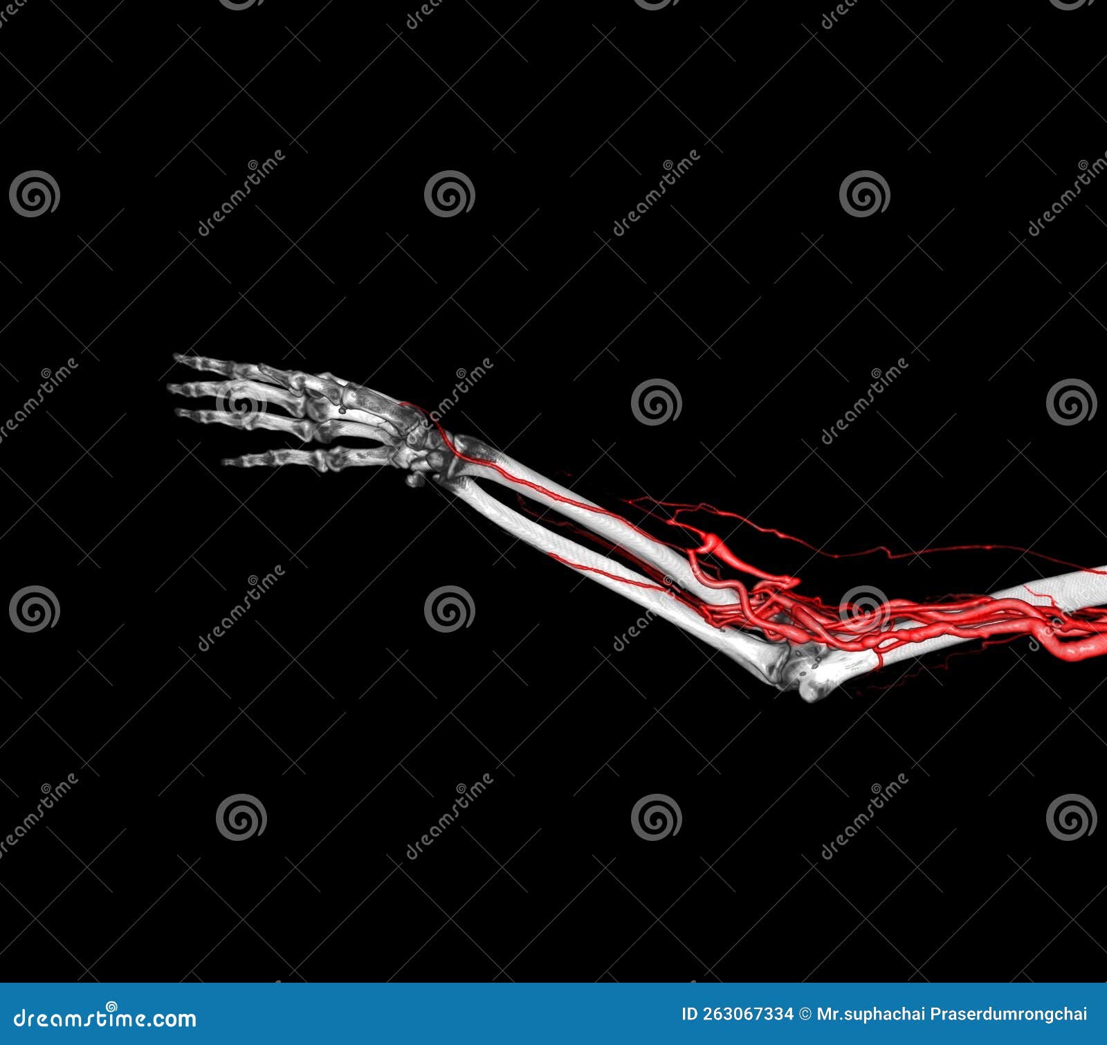 Brachial Arteries of the Arm with Upper Extremity Bone 3D Rendering ...