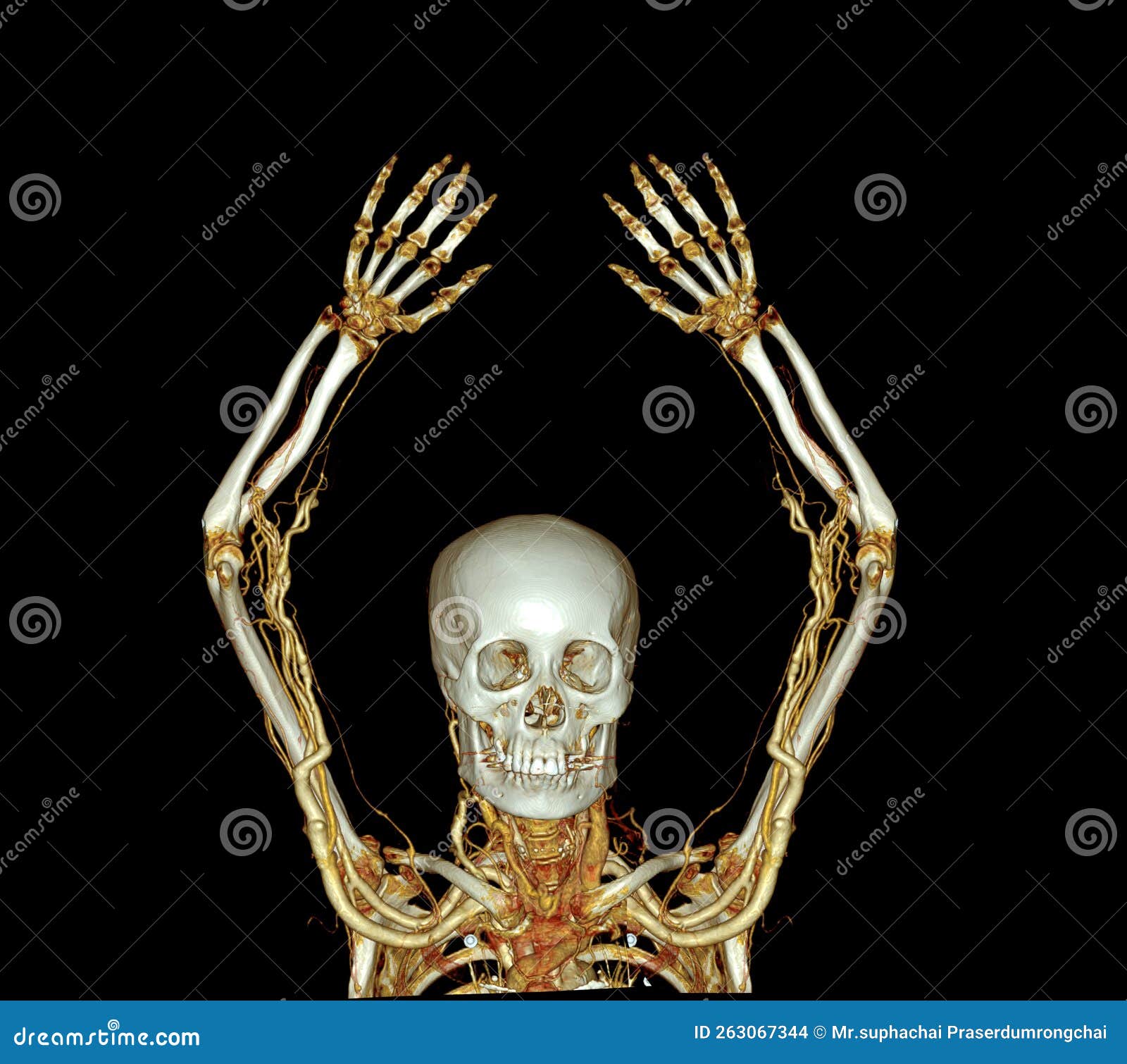 Brachial Arteries of the Arm with Upper Extremity Bone 3D Rendering ...