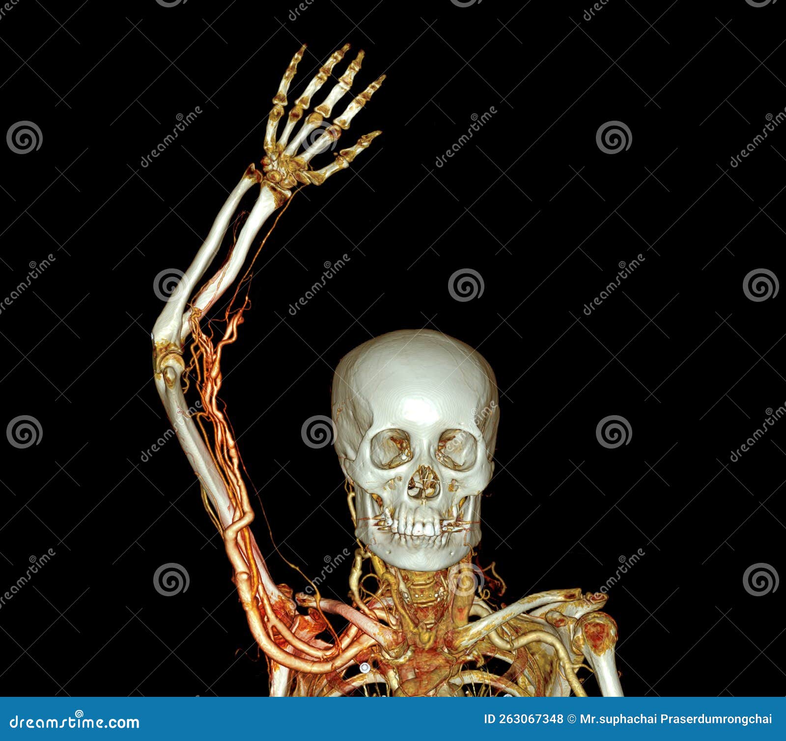 Brachial Arteries Of The Arm With Upper Extremity Bone 3D Rendering ...