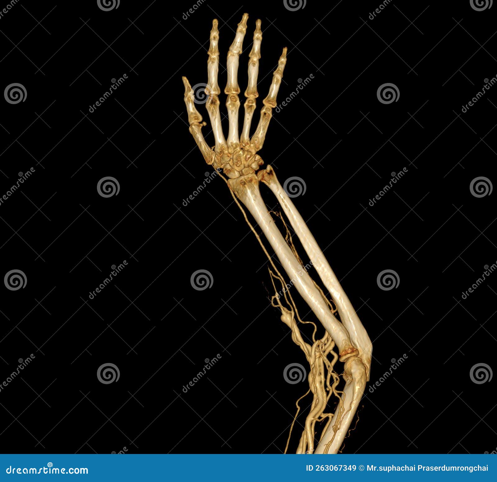Brachial Arteries Of The Arm With Upper Extremity Bone 3D Rendering ...