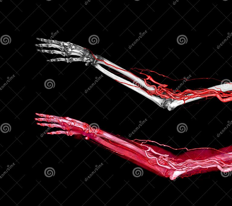 Brachial Arteries of the Arm with Upper Extremity Bone 3D Rendering ...