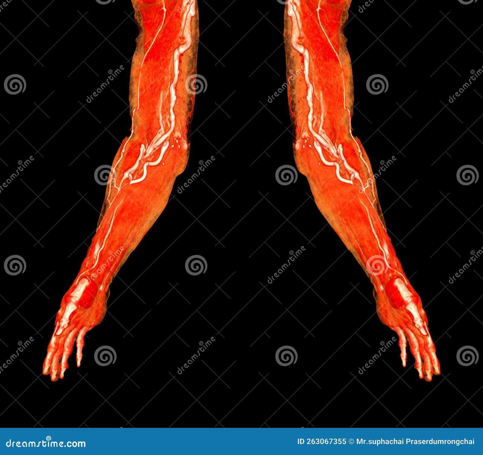 Brachial Arteries Of The Arm With Upper Extremity Bone 3D Rendering ...