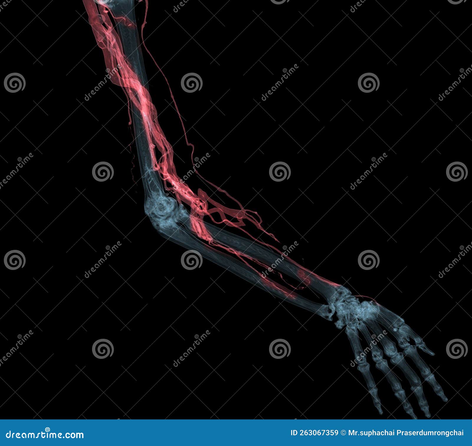 Brachial Arteries of the Arm with Upper Extremity Bone 3D Rendering ...