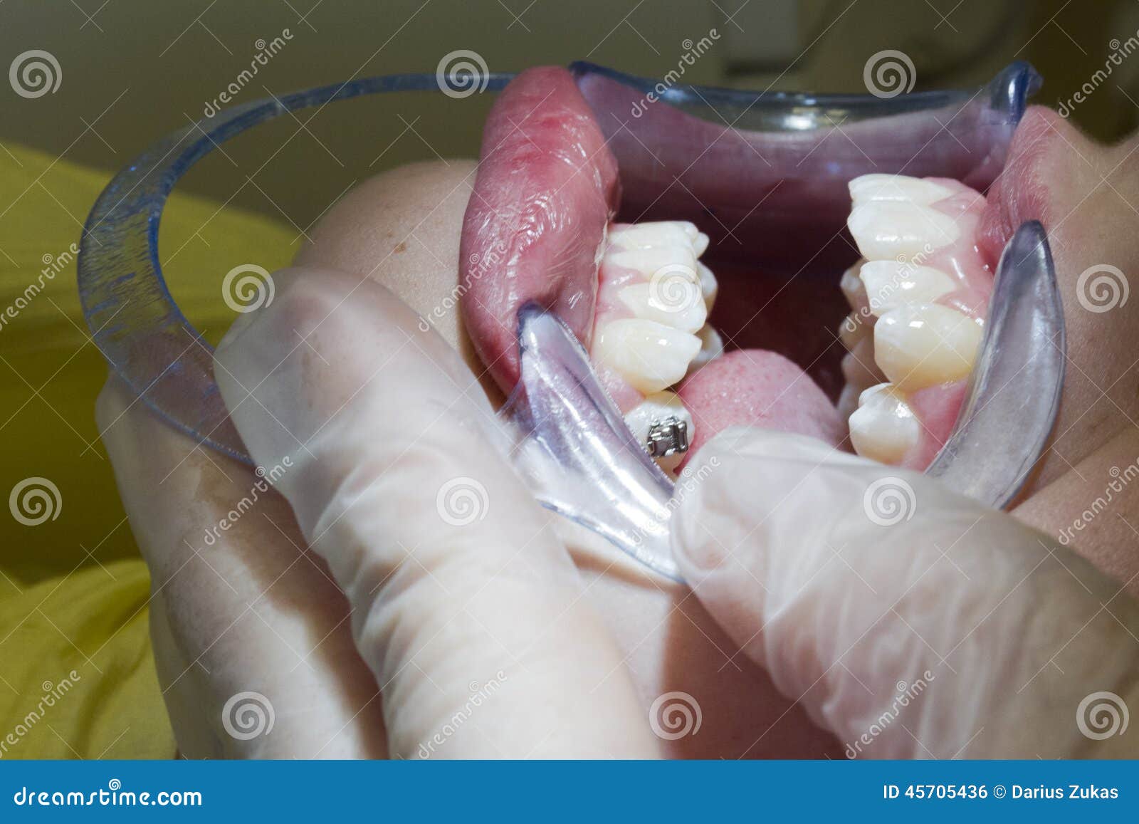 Brackets on the Teeth stock photo. Image of medical, work - 45705436