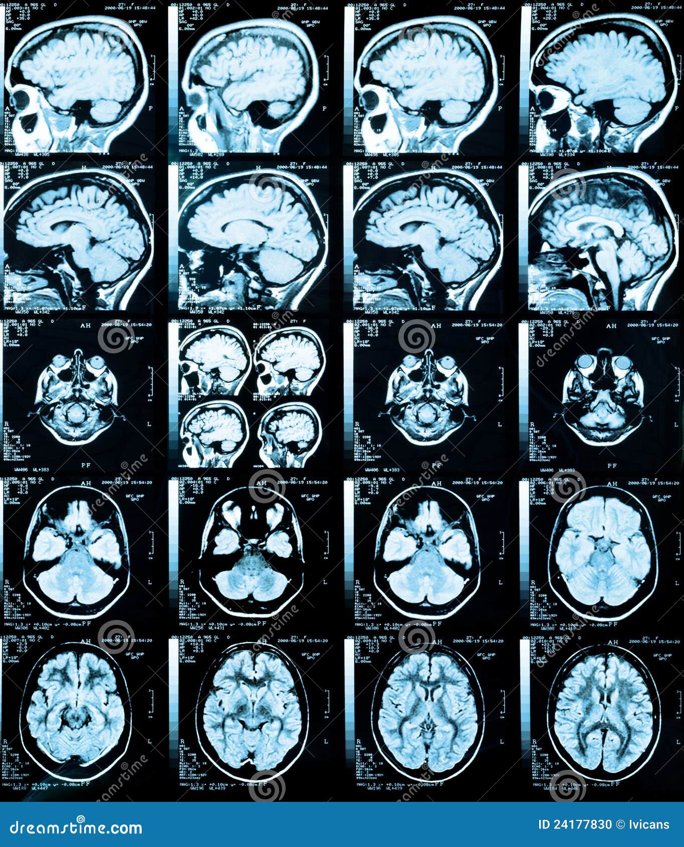 Brain stock photo. Image of medical, nuclear, medicine - 24177830