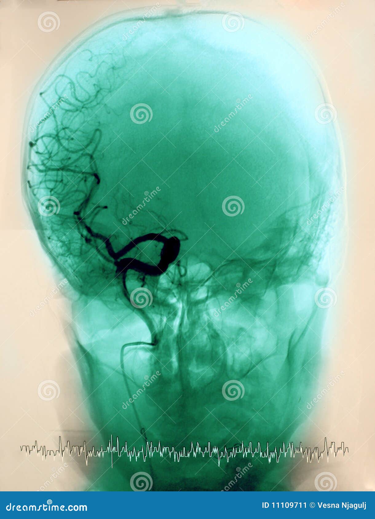 Brain Angiography, Arteriography, Radiology Stock Image - Image of ...
