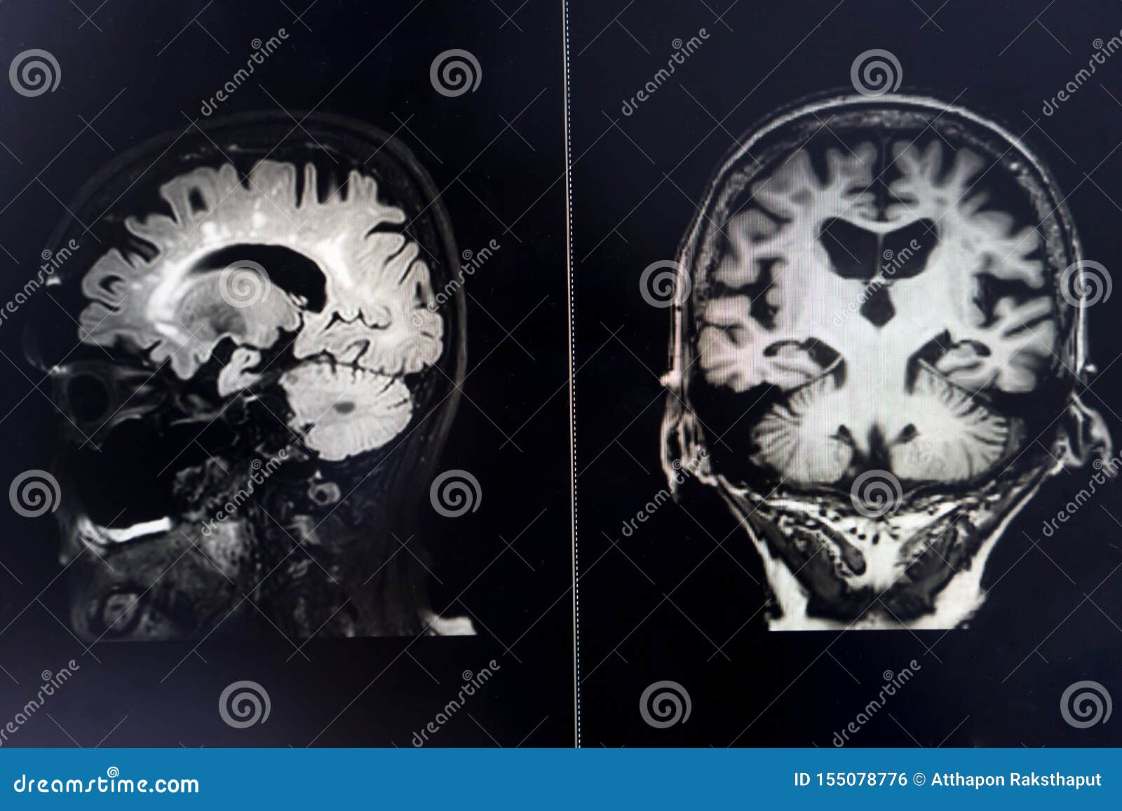 Brain Atrophy for Education and Diagnostic Stock Photo - Image of ...