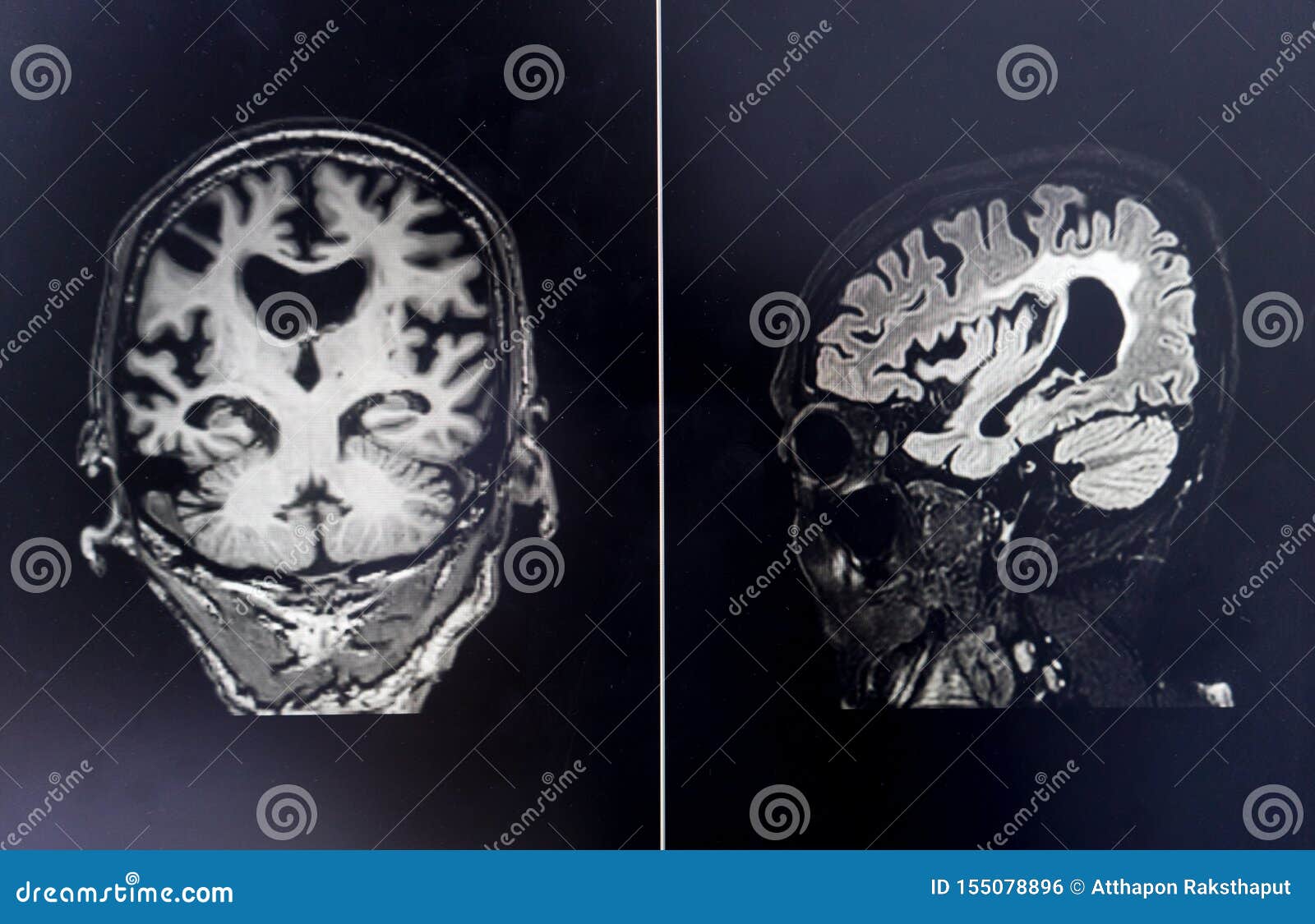 Brain Atrophy for Education and Diagnostic Stock Photo - Image of ...