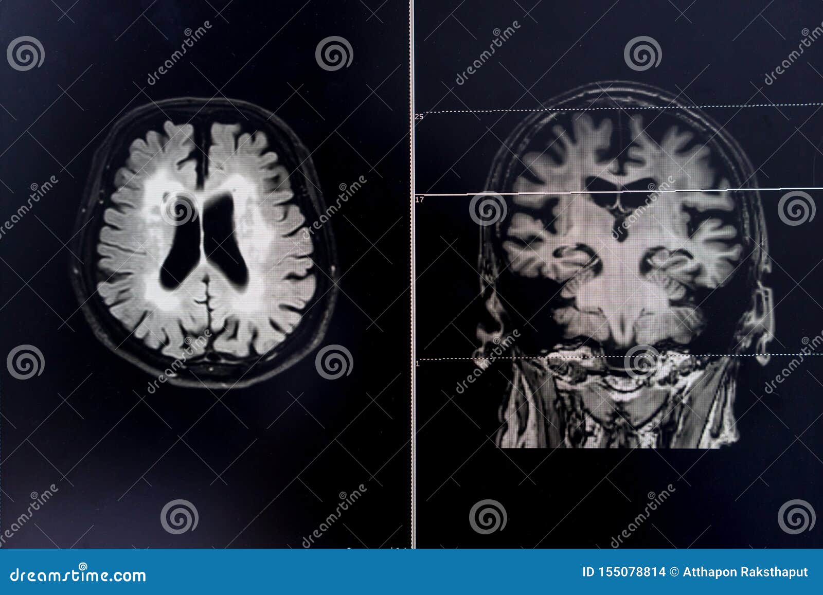 Brain Atrophy for Education and Diagnostic Stock Photo - Image of ...