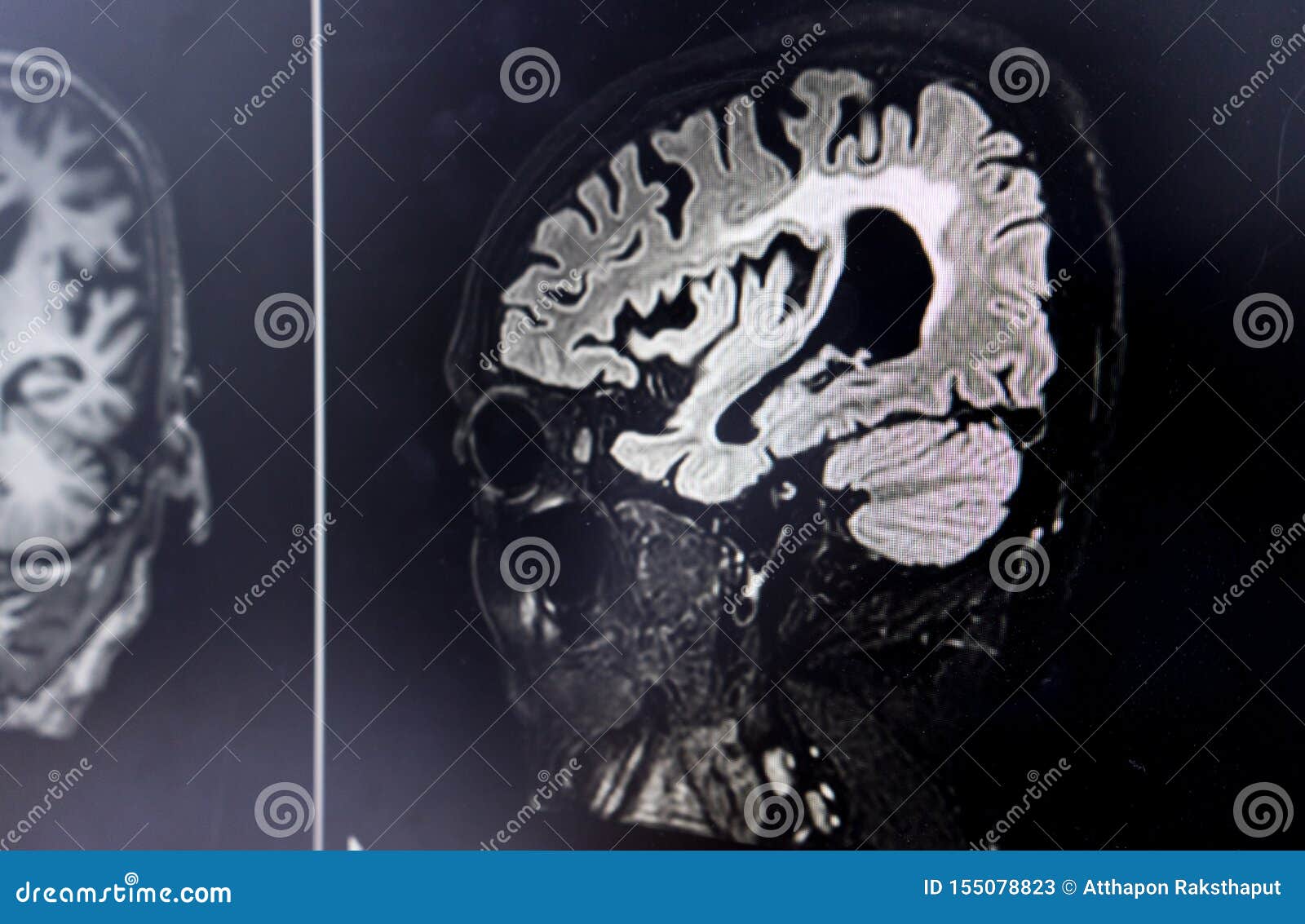 Brain Atrophy for Education and Diagnostic Stock Image - Image of ...