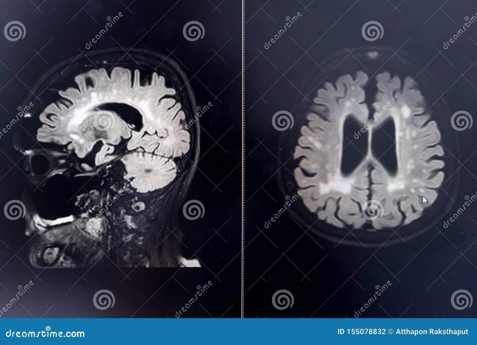 Brain Atrophy for Education and Diagnostic Stock Photo - Image of mixer ...