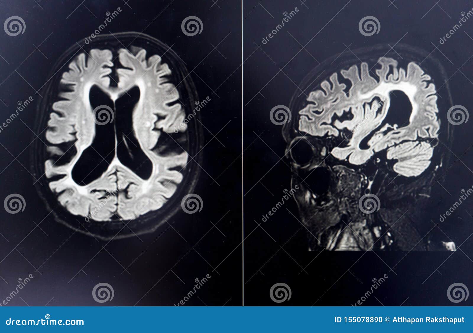 Brain Atrophy for Education and Diagnostic Stock Photo - Image of ...