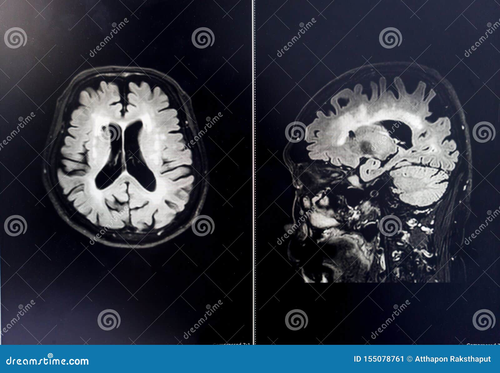 MRI THE BRAIN.Moderate Perilesional Vasogenic Edema With 0.7 Cm Midline ...
