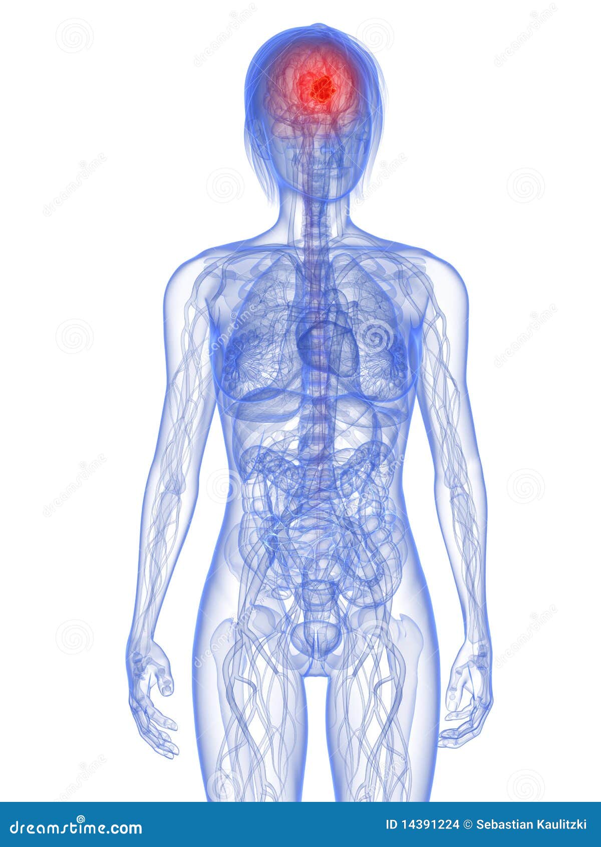 Brain cancer stock illustration. Illustration of metastasis - 14391224