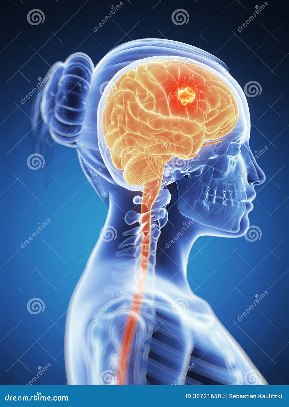 Brain cancer stock illustration. Illustration of lateral - 30721650