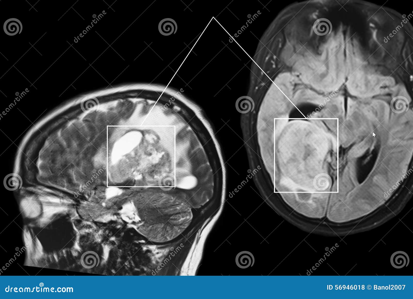 Brain cancer.MRI. stock photo. Image of isolated, radiology - 56946018