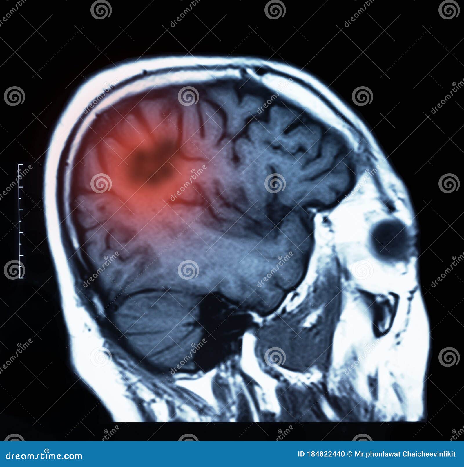 Brain cancer x-ray image stock photo. Image of disease - 184822440