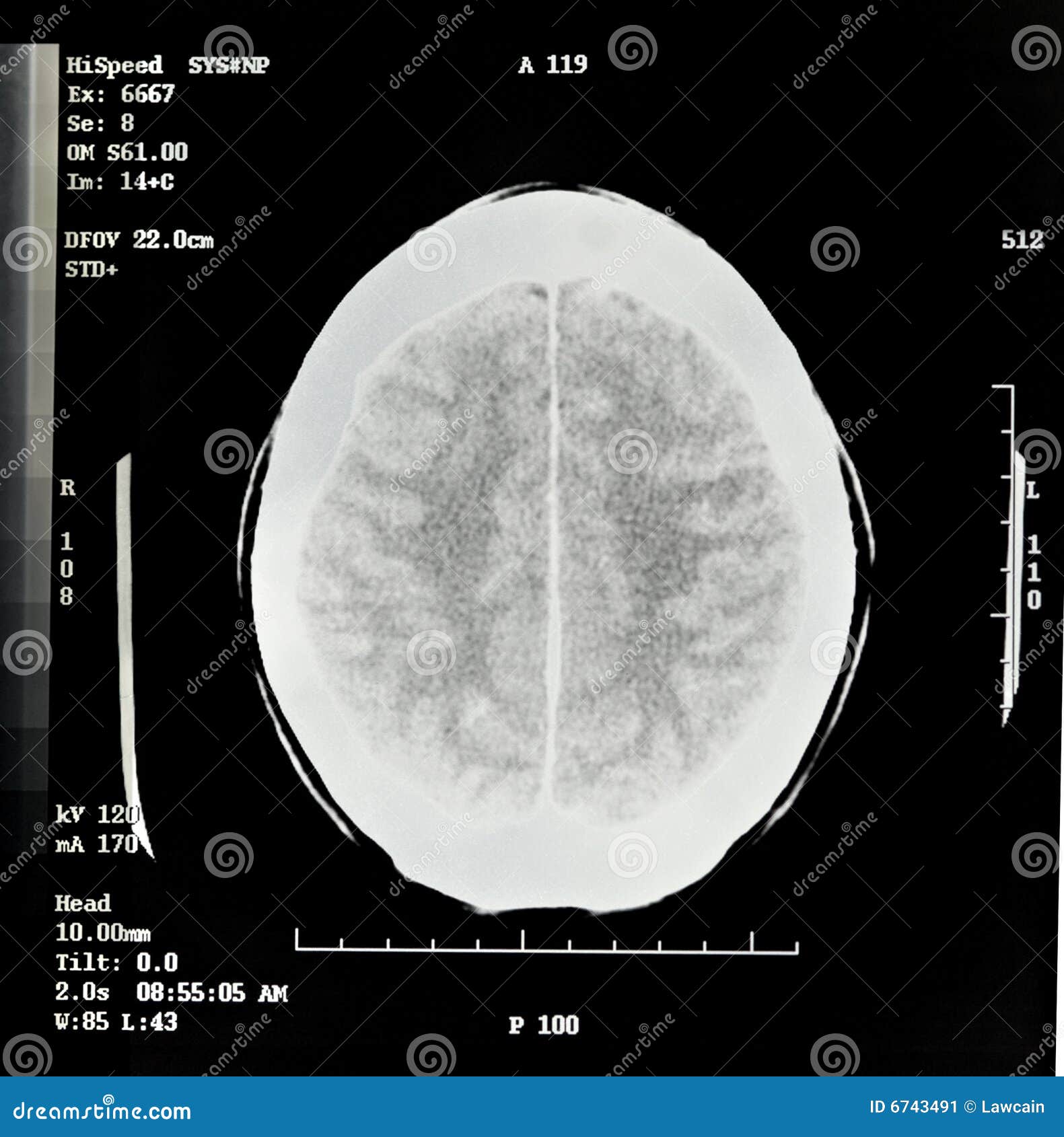 Brain CAT Scan stock image. Image of iodine, axial, brains - 6743491