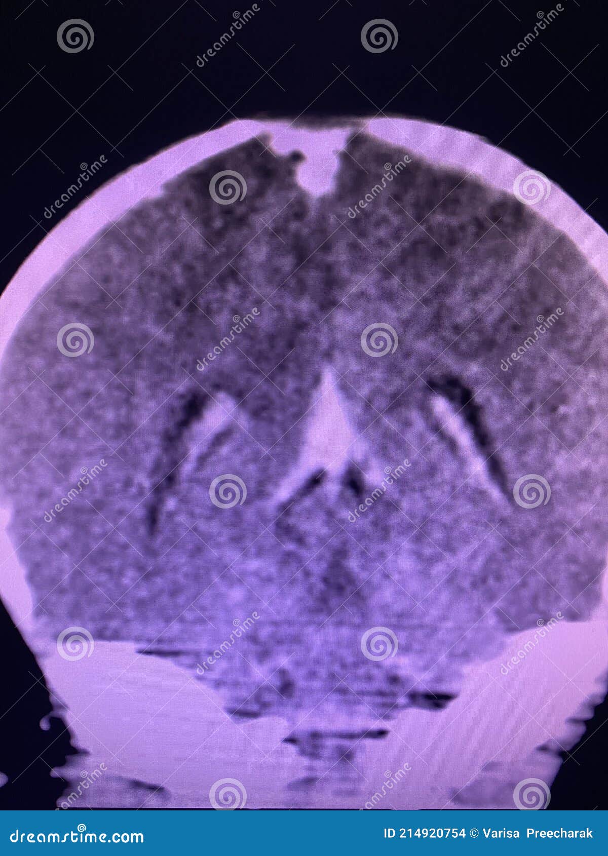Brain computed tomography stock photo. Image of neurology - 214920754