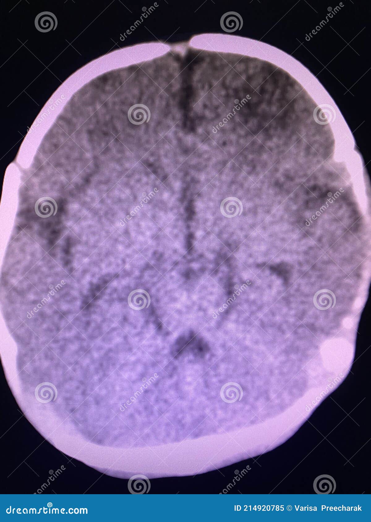Brain computed tomography stock image. Image of posterior - 214920785