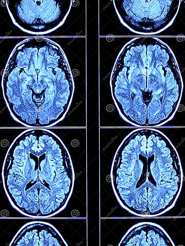 Brain CT Scan stock image. Image of exam, diagnostic, action - 5107925