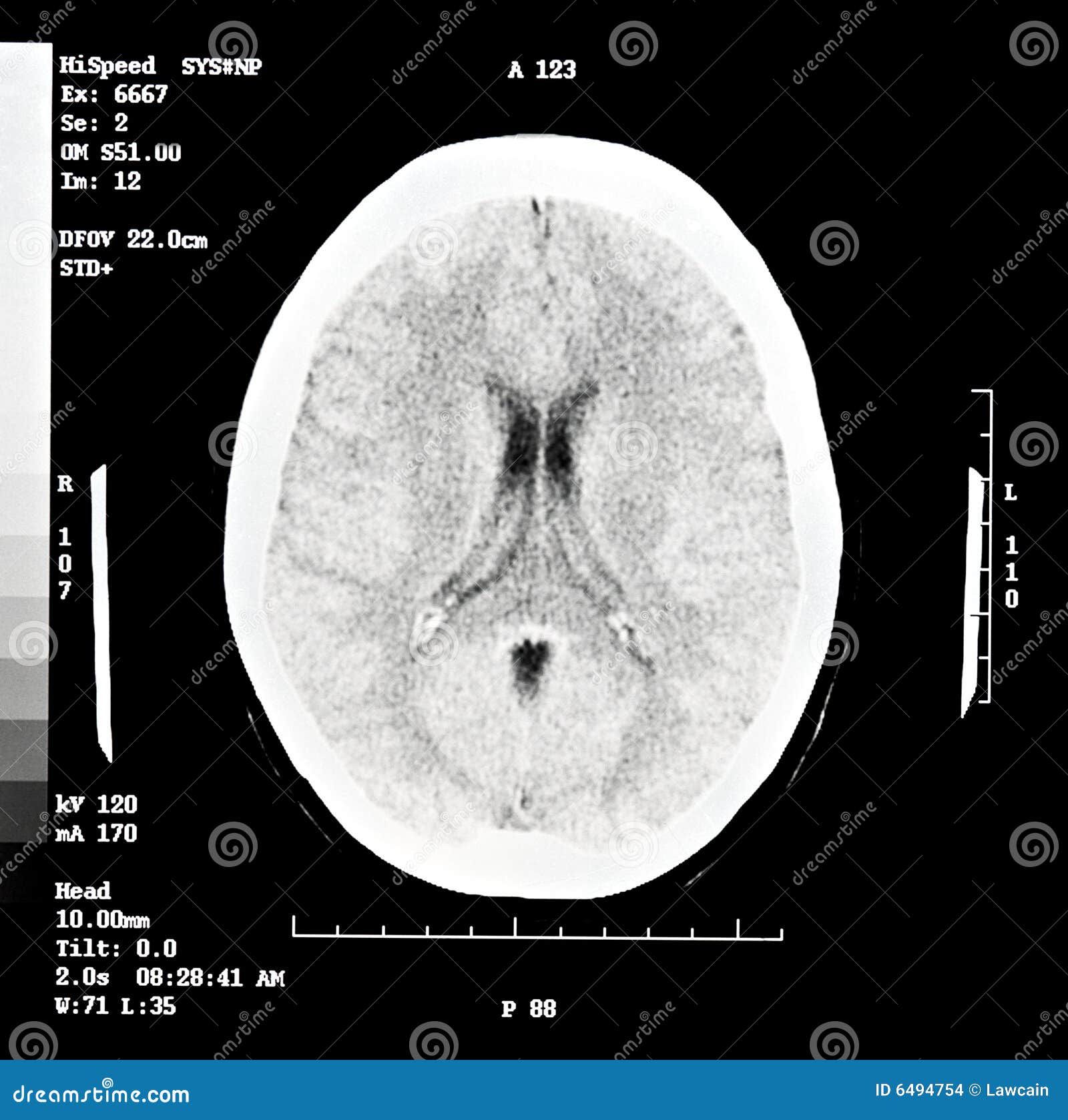 Brain CT Scan Stock Images - Image: 6494754