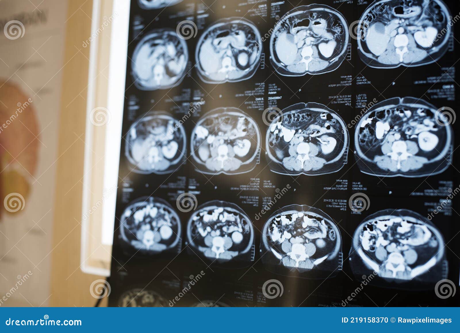 Brain CT scan x-ray film stock photo. Image of xray - 219158370