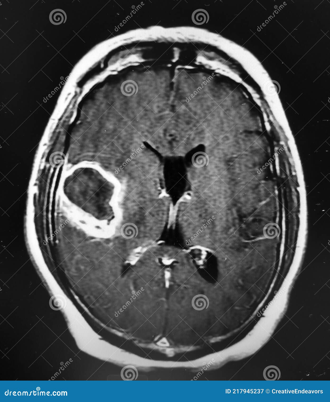 Brain CT Showing E. Coli Brain Abscess Stock Image - Image of enhance ...