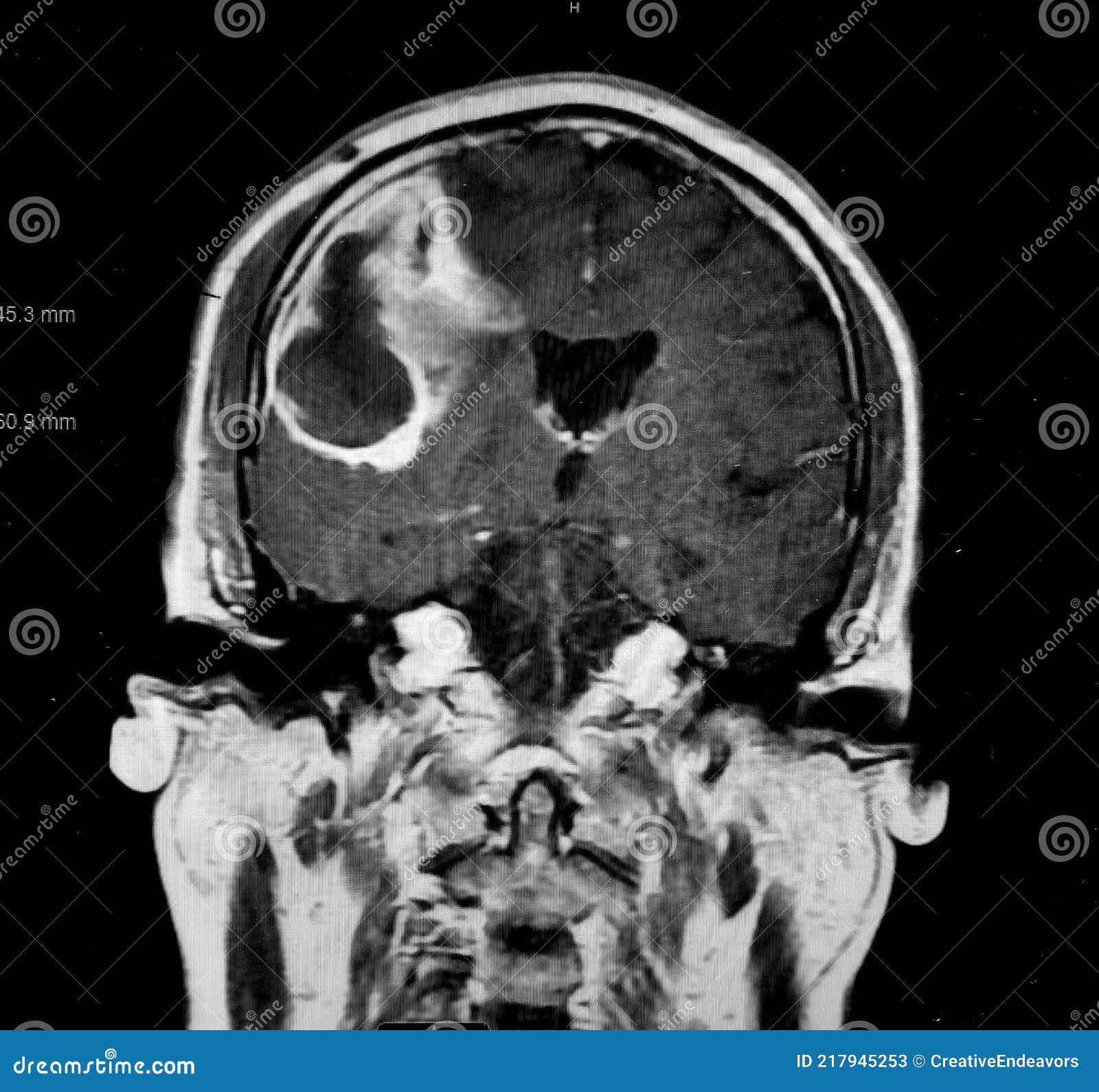 Brain CT Showing E. Coli Brain Abscess Stock Image - Image of seizures ...