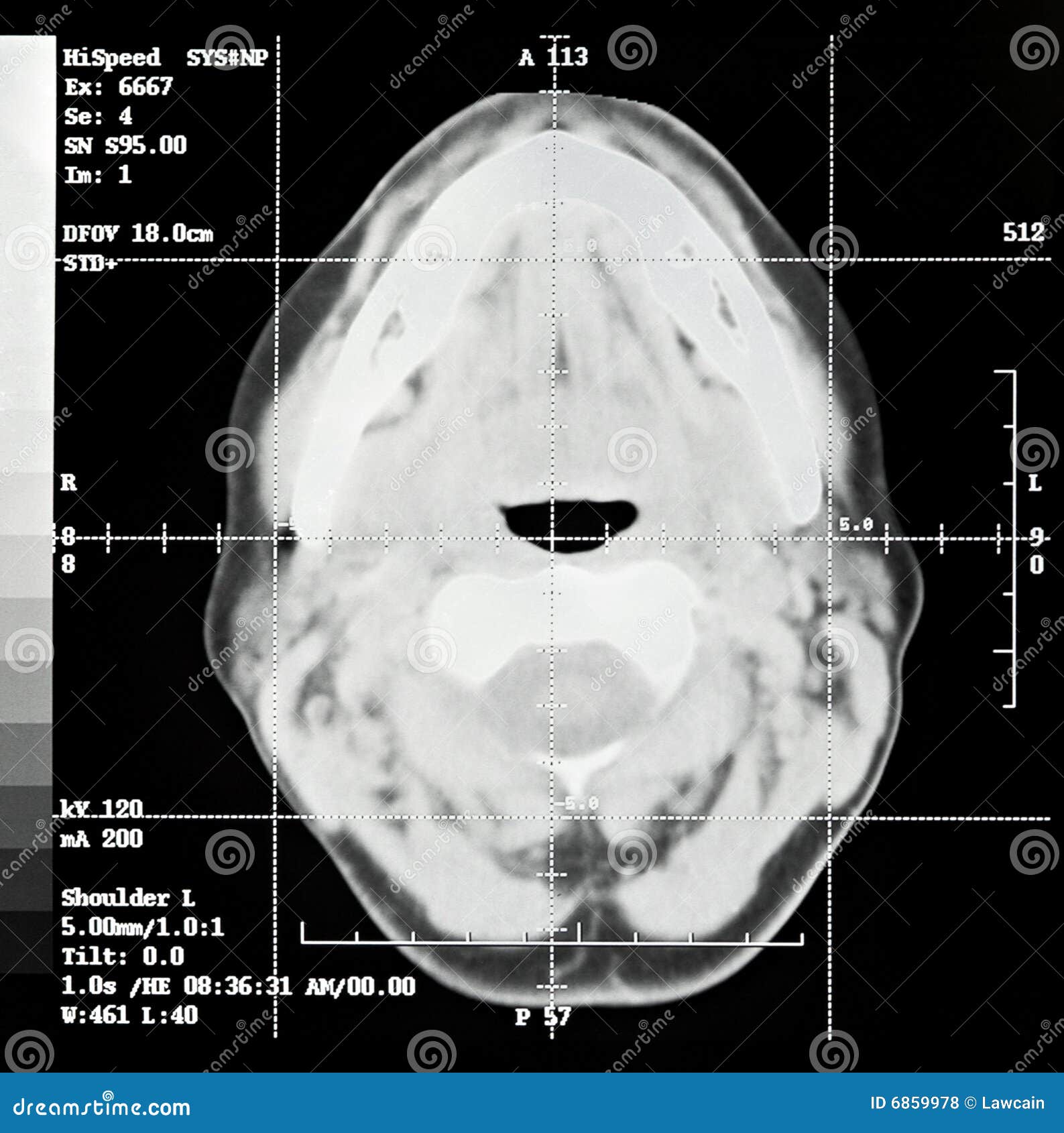 Brain CT Slice stock photo. Image of organs, computed - 6859978