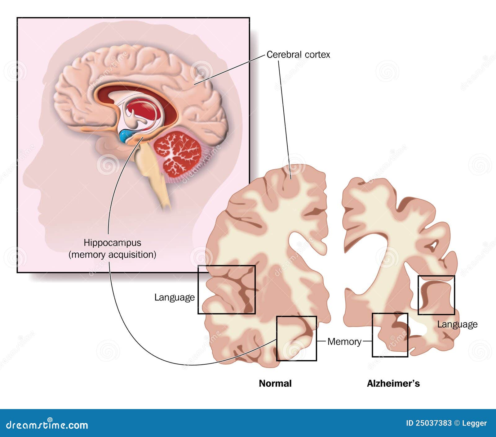 Brain Damage in Alzheimer S Stock Illustration - Illustration of cortex ...
