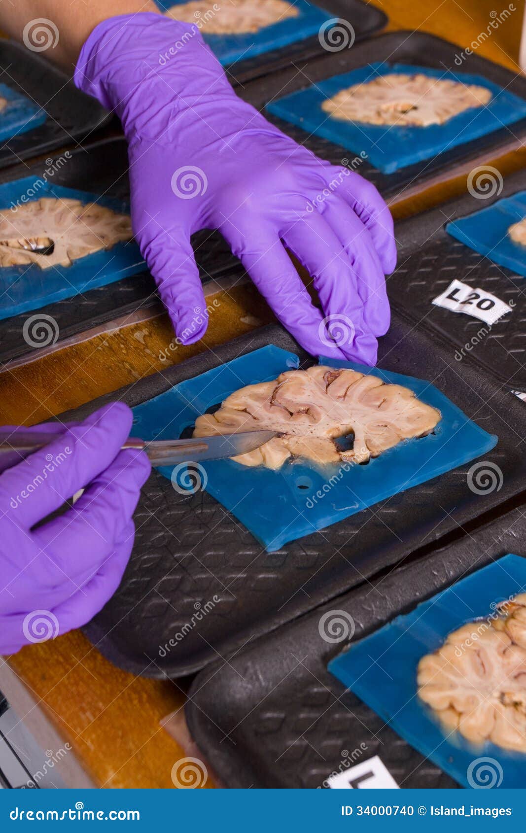 Brain examination in lab stock photo. Image of disease - 34000740