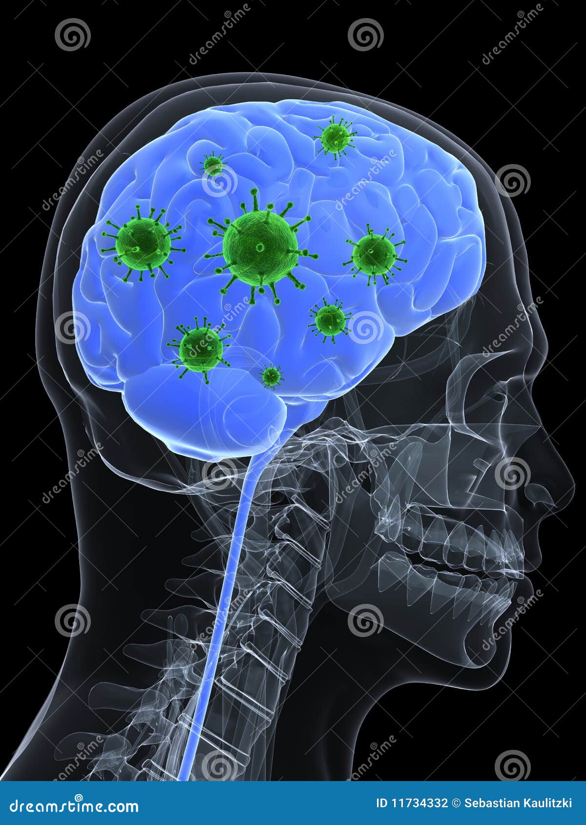 Brain infection stock illustration. Illustration of anatomy - 11734332