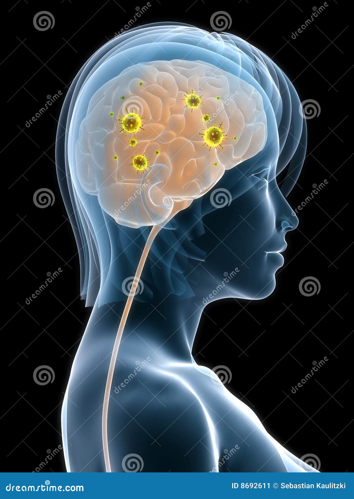 Brain infection stock illustration. Illustration of headache - 8692611