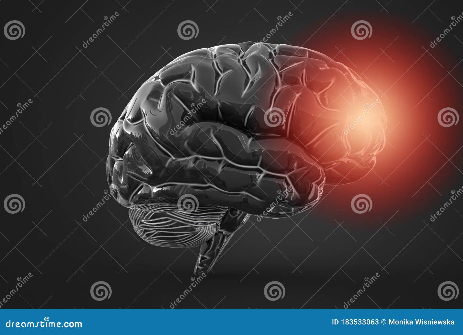 Brain Inflammation or Brain Disease Stock Illustration - Illustration ...