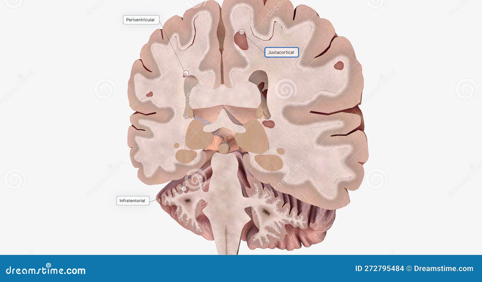 Brain Lesions. Cerebrum Captured By Bacteria. Mutations Modify Organ Or ...