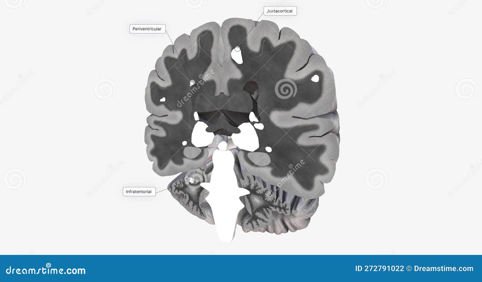 Brain Lesions. Cerebrum Captured By Bacteria. Mutations Modify Organ Or ...