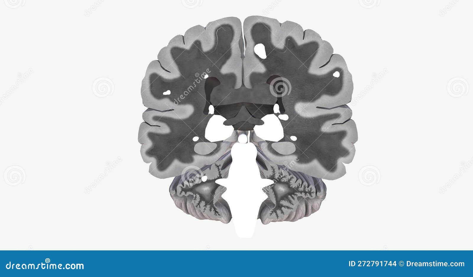 The Brain with lesions MRI stock illustration. Illustration of ...