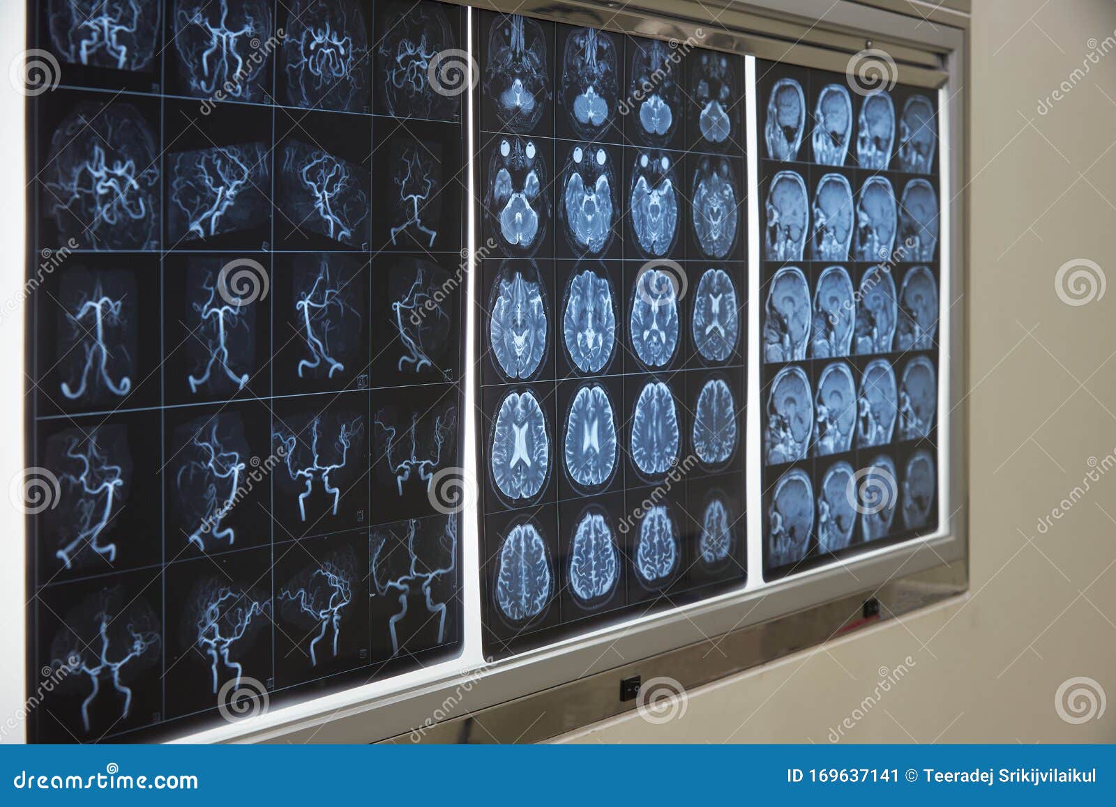 Brain Magnetic Resonance Imaging on the Lightbox Stock Image - Image of ...