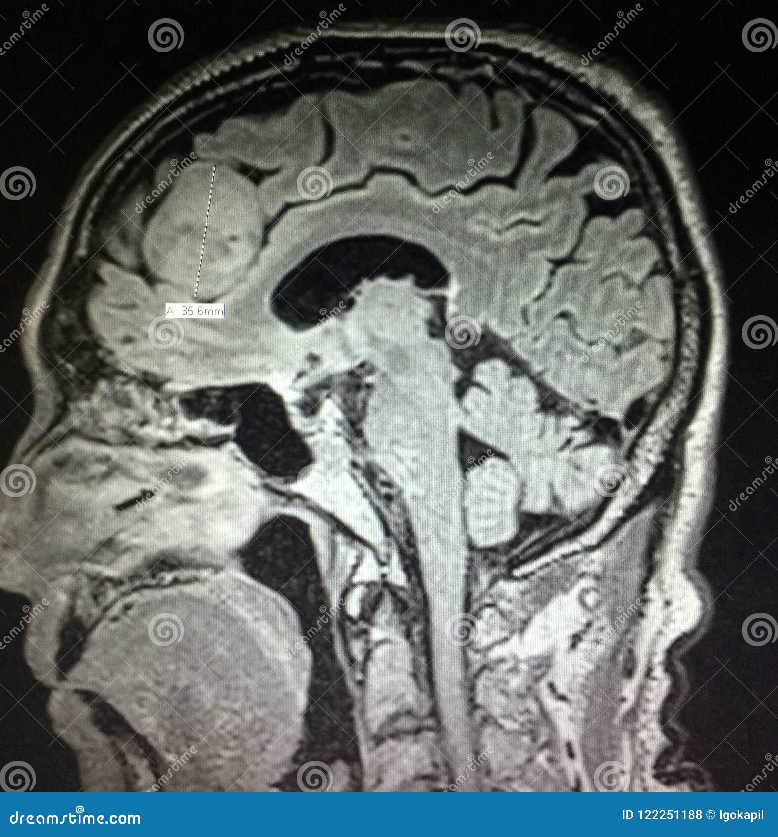 Brain Meningioma Pointing Mri Examination Stock Photo - Image of ... Brain Meningioma Pointing Mri Examination Stock Photo - Image of ...