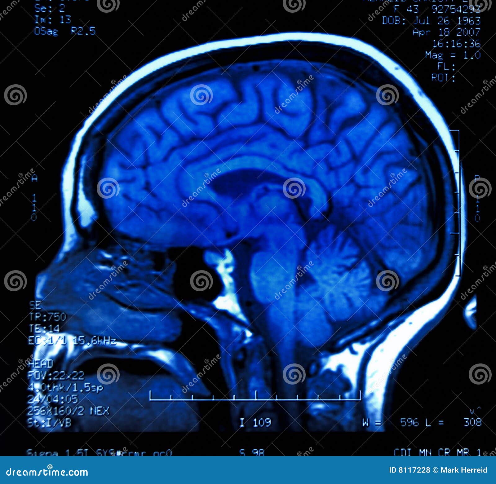 Brain MRI stock photo. Image of tomographic, resonance - 8117228
